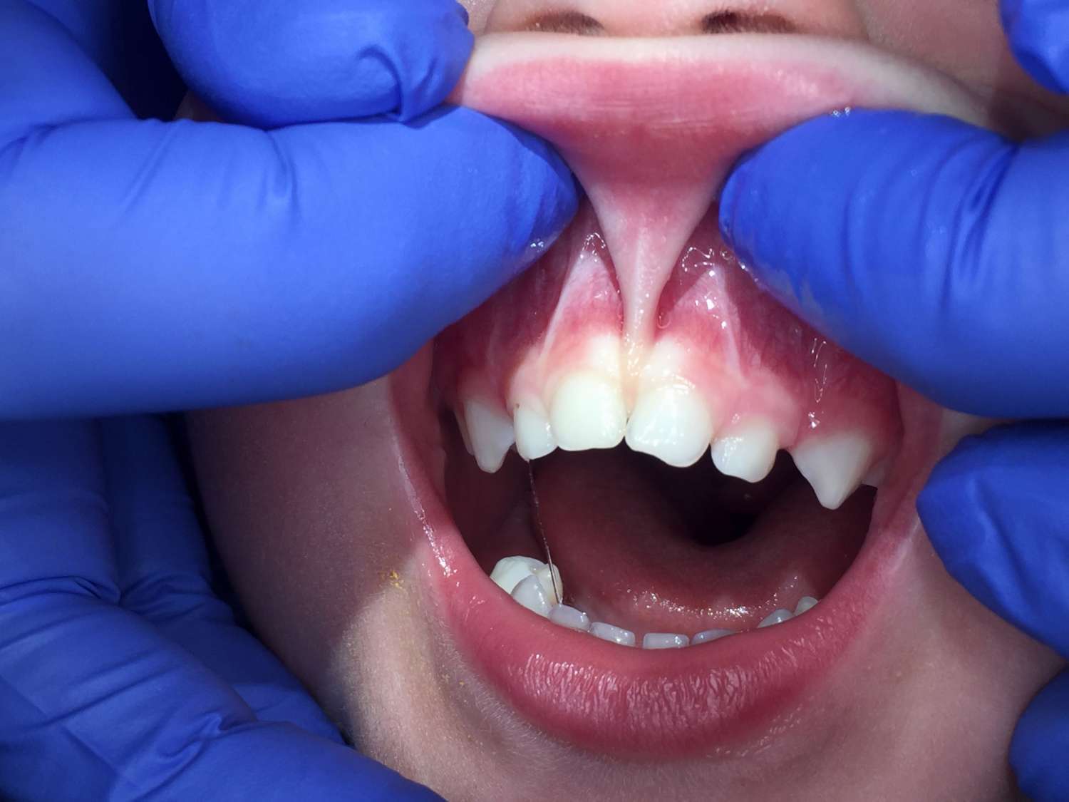 A Parent's Guide to Tongue-Tie – Heart & Soul Speech